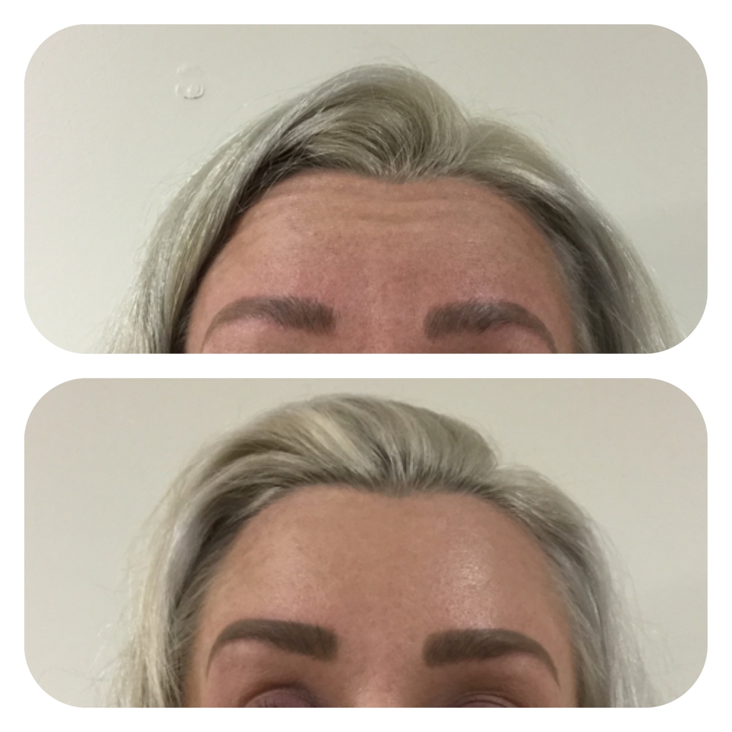 ReNew You Med Spa in Minnesota - Before & After